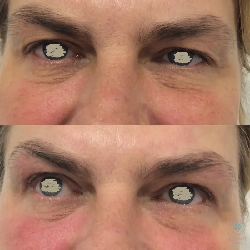 Ulthera HIFU - Body Care Clinic